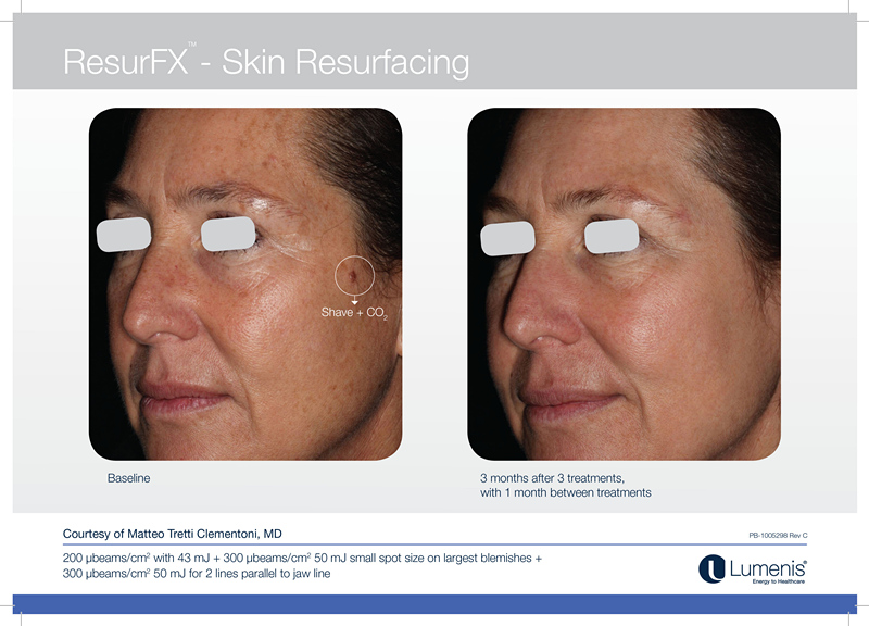 Resurfx Laser Treatment in Markham, Toronto, Laser Fractional in ...