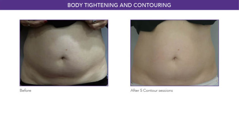 EndyMed 3DEEP® Body RF Contouring and Cellulite Treatment – Genesis ...