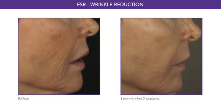 EndyMed 3DEEP® RF Fractional Skin Resurfacing – Genesis Medi Clinic 创世纪医学诊所