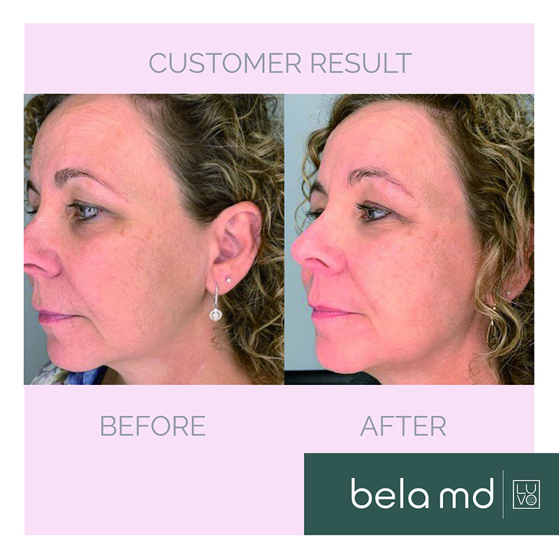 Bela MD Treatment in Richmond Hill | Genesis Medi Clinic