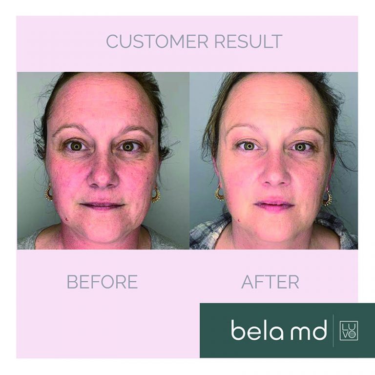 Bela MD Treatment in Richmond Hill | Genesis Medi Clinic