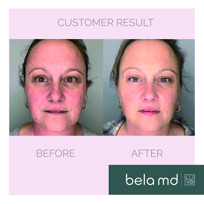 Bela MD Treatment in Richmond Hill | Genesis Medi Clinic