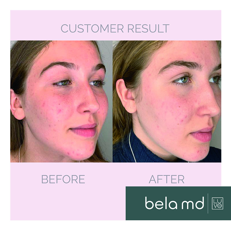 Bela MD Treatment in Richmond Hill | Genesis Medi Clinic