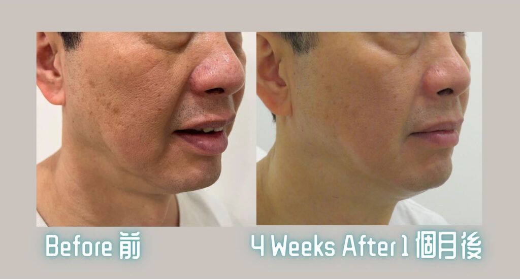 Sofwave™ Ultrasound Treatment – Genesis Medi Clinic 创世纪医学诊所